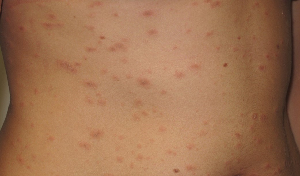 PITIRIASIS: ALBA, ROSADA, VERSICOLOR – Farmacia ULM – San Fulgencio ...